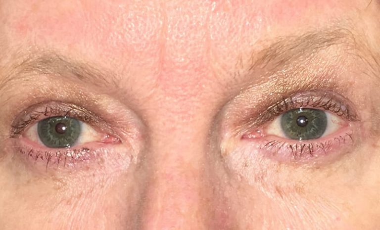 bilateral-upper-eyelid-blepharoplasty-after - Nissman Eye