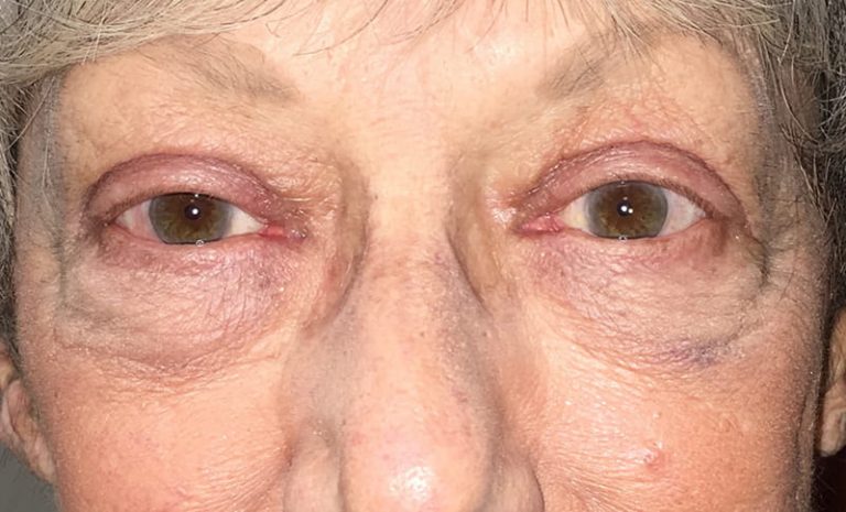 bilateral-upper-eyelid-blepharoplasty-bilateral-removal-of-lower-eyelid ...