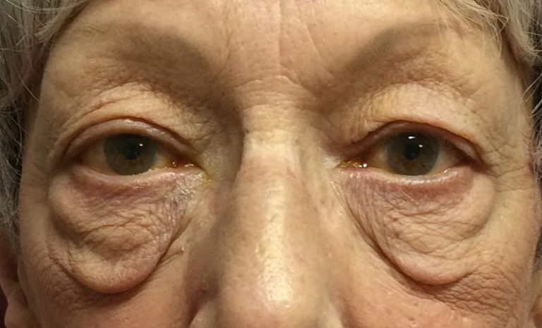 bilateral-upper-eyelid-blepharoplasty-bilateral-removal-of-lower-eyelid ...