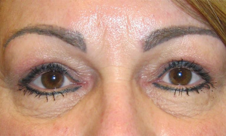 bilateral-upper-eyelid-blepharoplasty-correction-of-drooping-upper ...