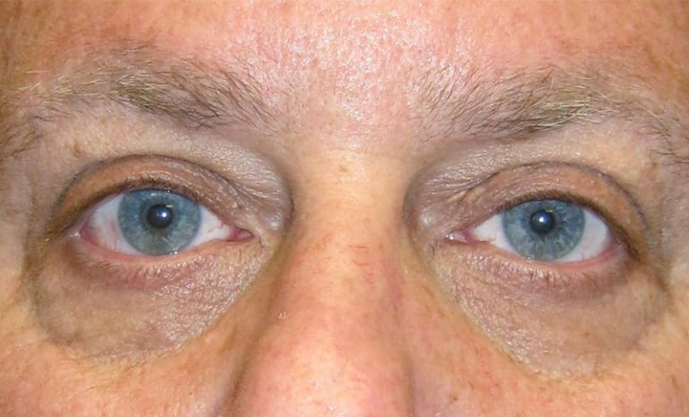 correction-of-bilateral-drooping-upper-eyelids-ptosis-after - Nissman Eye