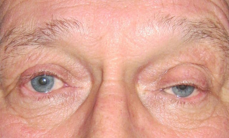 correction-of-bilateral-drooping-upper-eyelids-ptosis-before - Nissman Eye