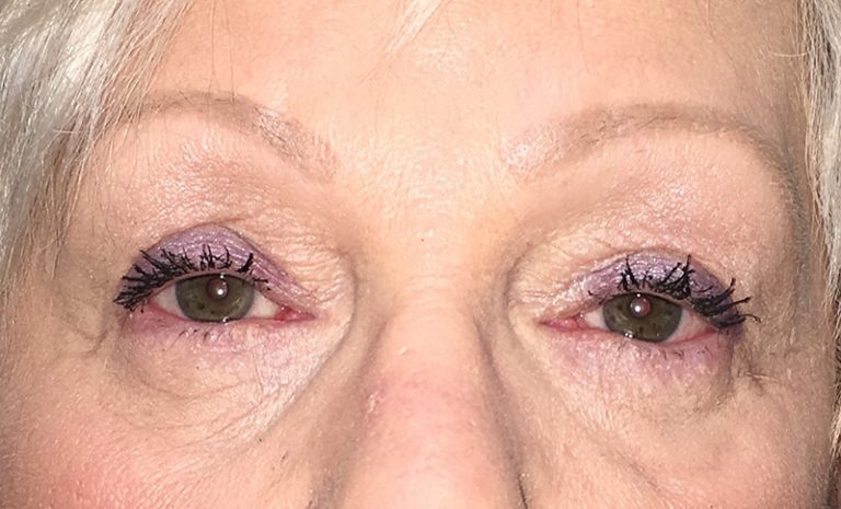 correction-of-bilateral-drooping-upper-eyelids-ptosis-before - Nissman Eye