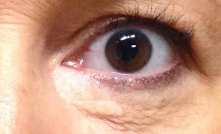 revision-of-left-lower-eyelid-scarred-skin-graft-scar-before - Nissman Eye