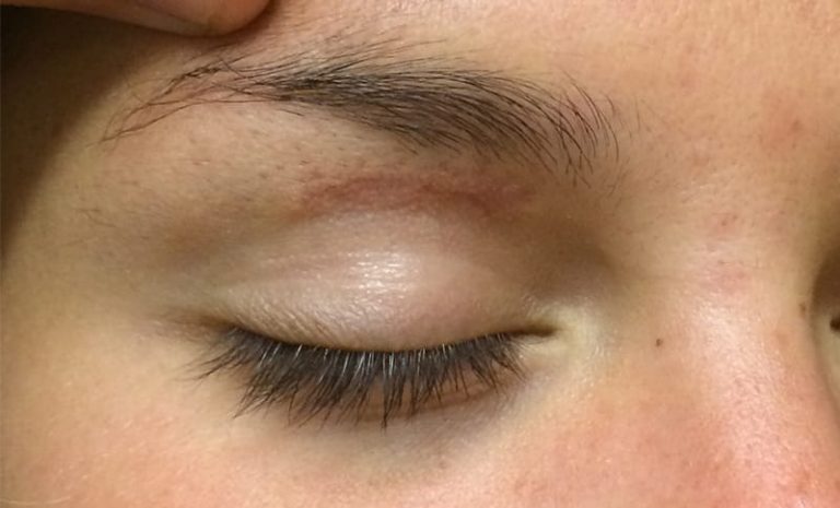 revision-of-unsightly-scar-from-a-bad-soccer-injury-after - Nissman Eye